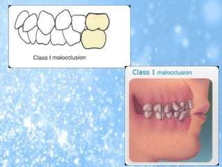ANGLE'S CLASSIFICATION OF MALOCCLUSION | PPTX