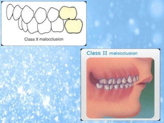 ANGLE'S CLASSIFICATION OF MALOCCLUSION | PPT