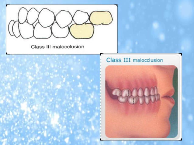 ANGLE'S CLASSIFICATION OF MALOCCLUSION | PPT