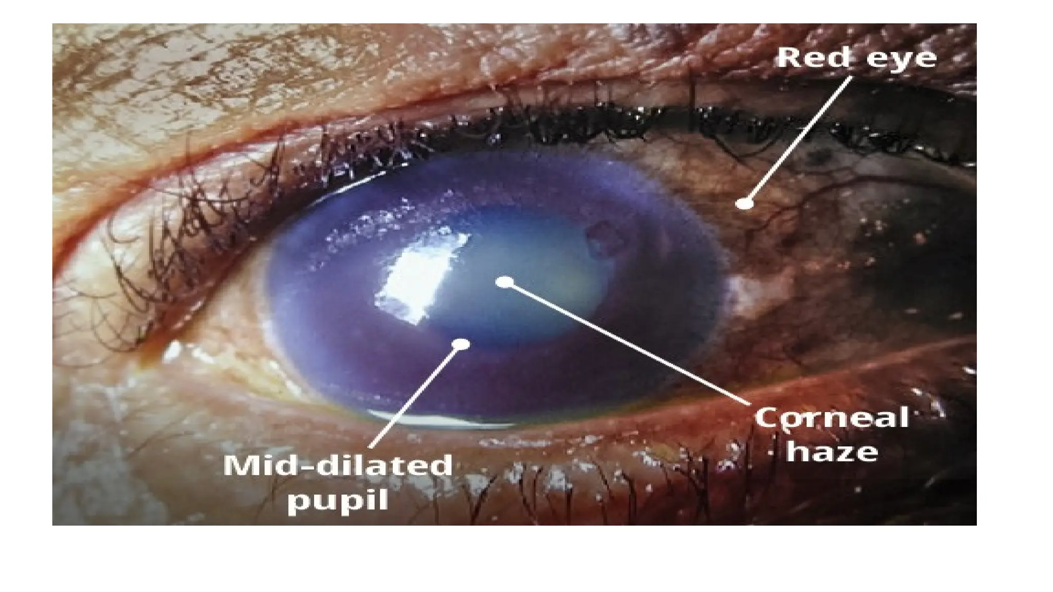 Angle Closure ophthalmology for medical students | PPT
