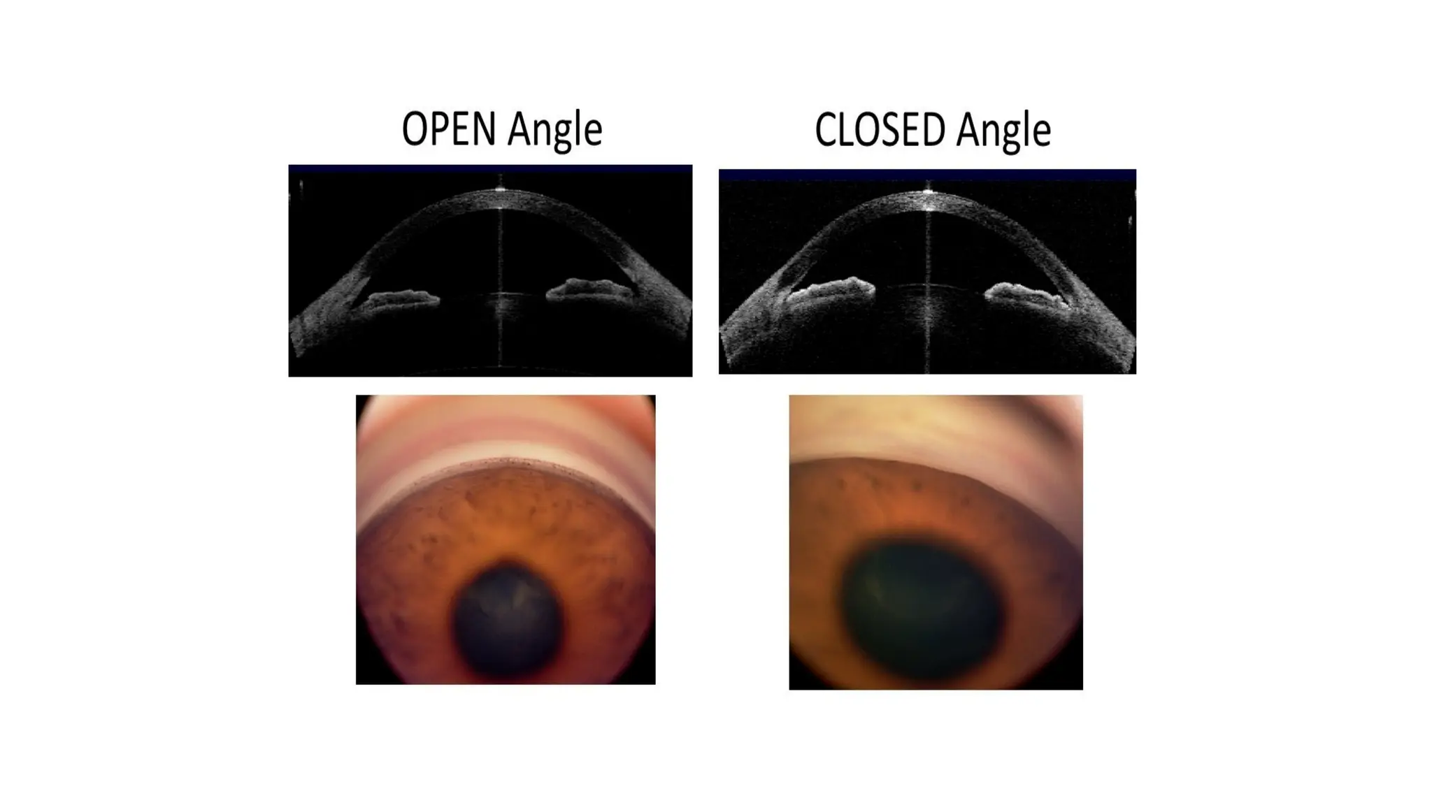 Angle Closure ophthalmology for medical students | PPT