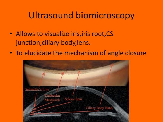 Angle closure glaucoma | PPTX