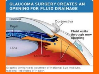 Angle closure glaucoma | PPTX