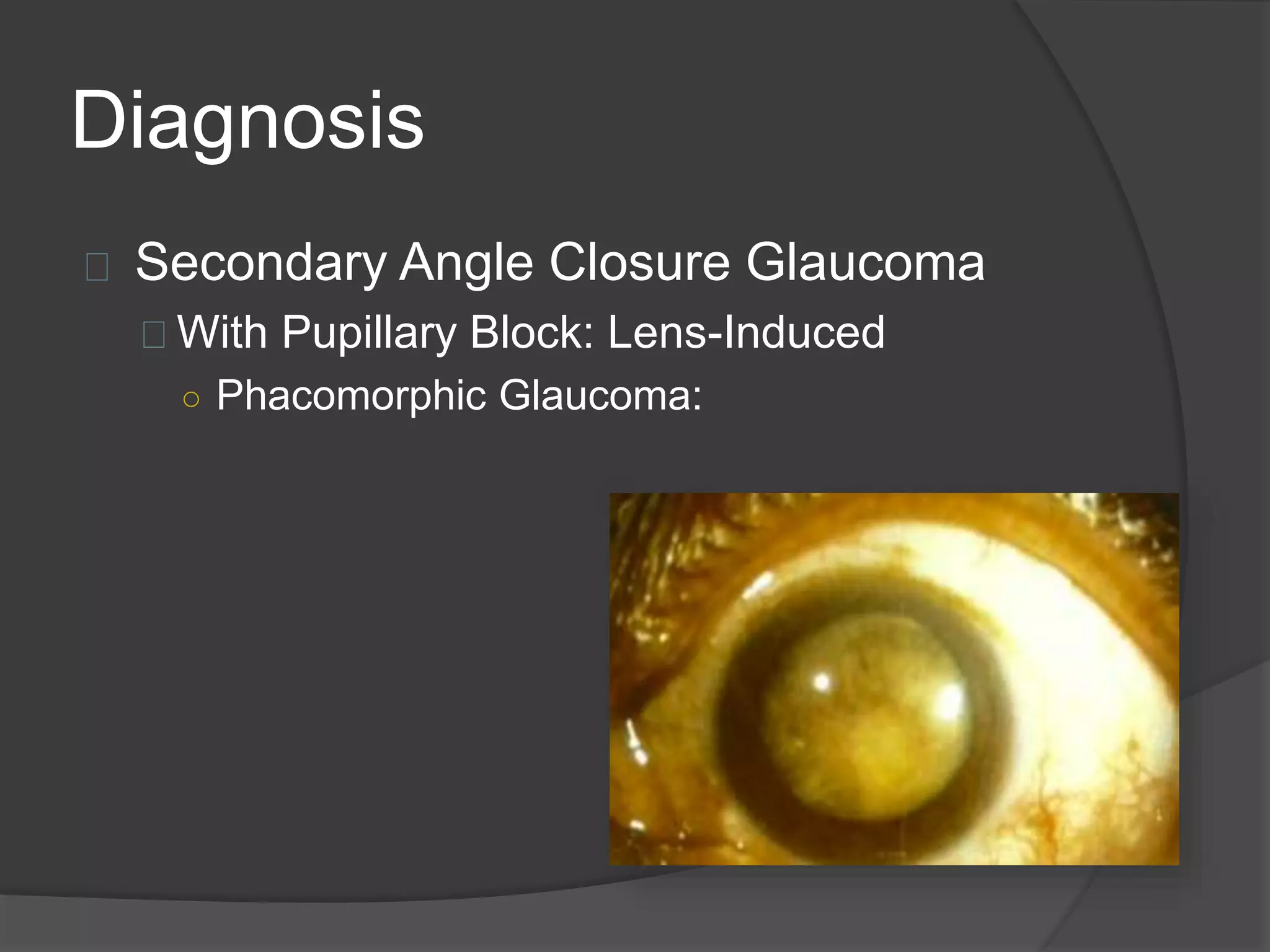 Angle Closure Glaucoma | PPTX
