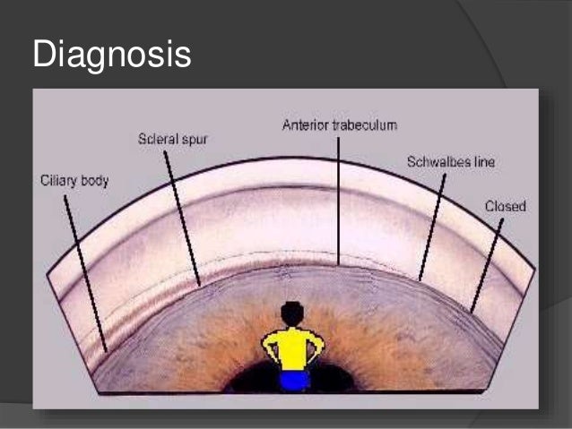 Angle Closure Glaucoma