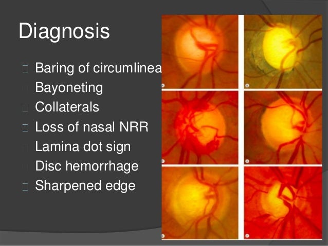 Angle Closure Glaucoma