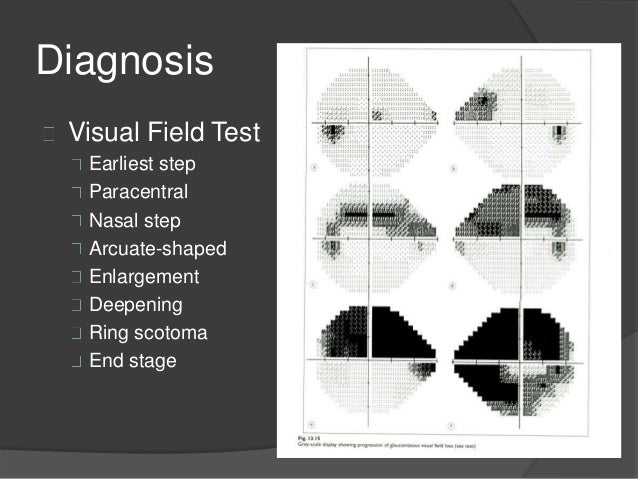 Angle Closure Glaucoma