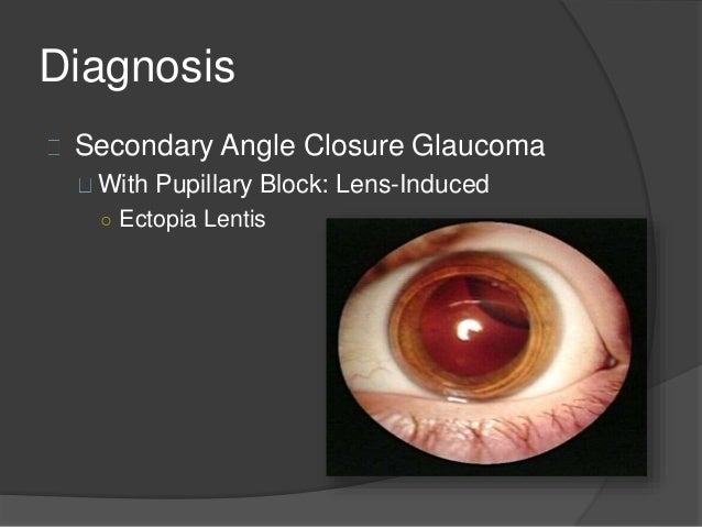Angle Closure Glaucoma