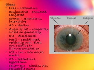 Angle closure glaucoma | PPT