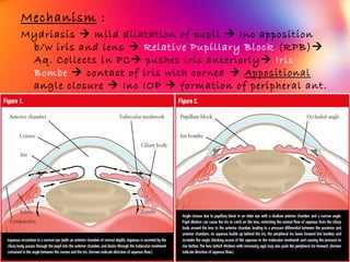 Angle closure glaucoma | PPT
