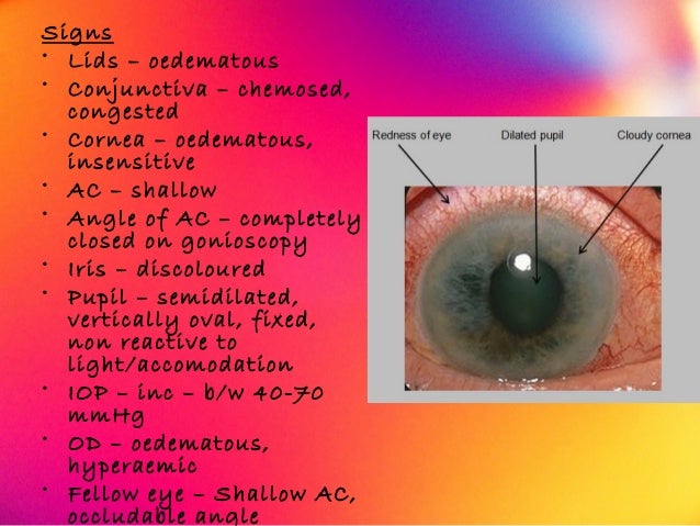 Angle closure glaucoma