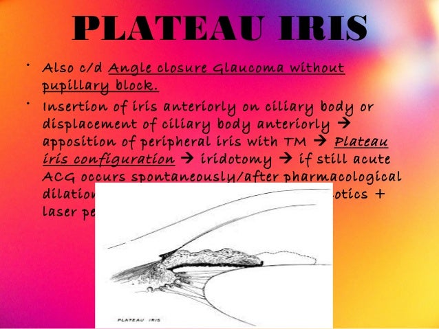 Angle closure glaucoma