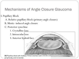 Shallow Anterior Chamber With Pupillary Block