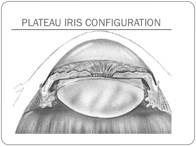 Angle closure glaucoma