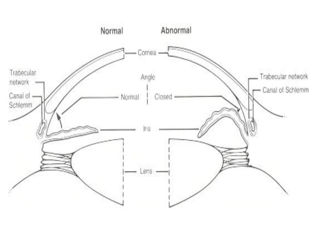 Angle Closure Glaucoma primary_061832.pdf