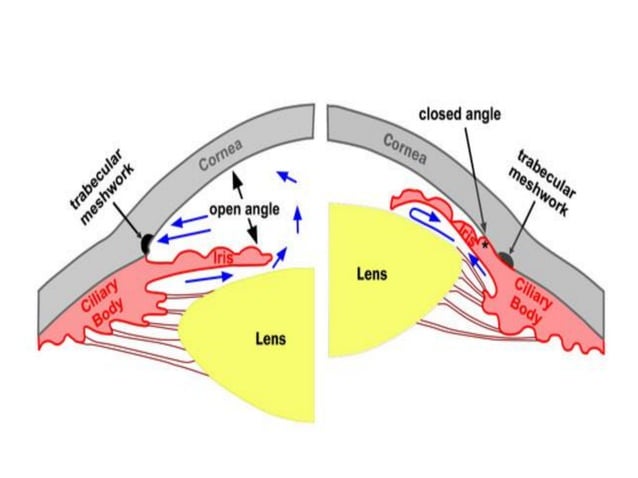 Angle Closure Glaucoma primary_061832.pdf
