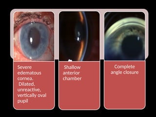 ANGLE CLOSURE GLAUCOMA SIMPLE REVIEW.pptx