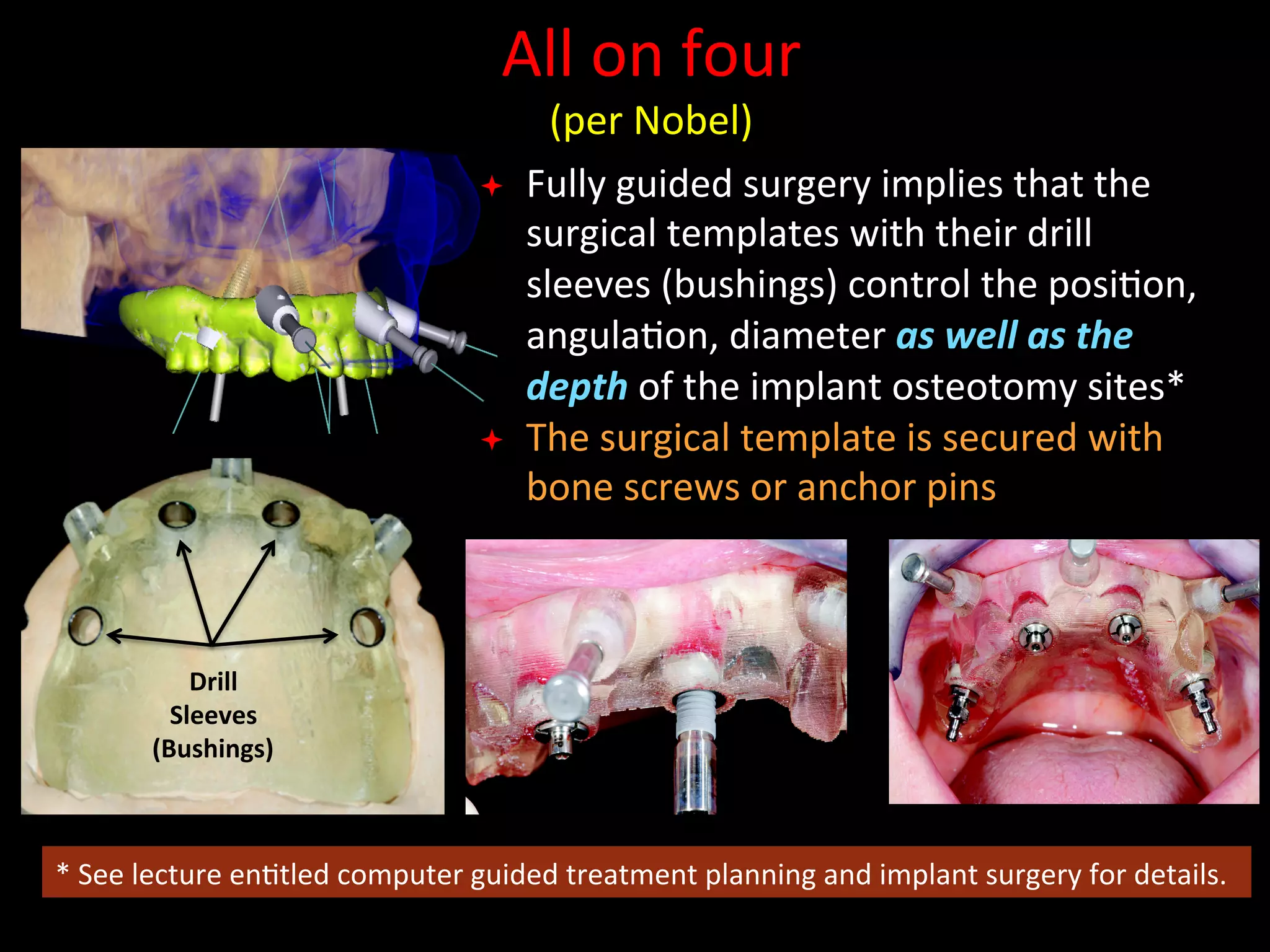 Angled implants | PDF
