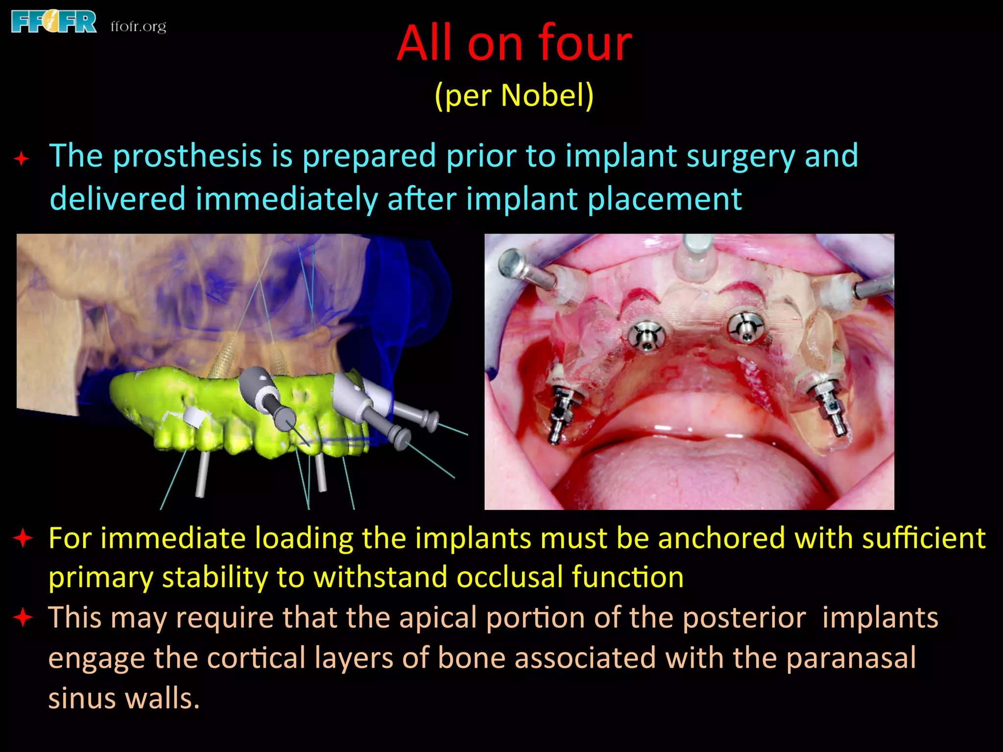 Angled implants | PDF