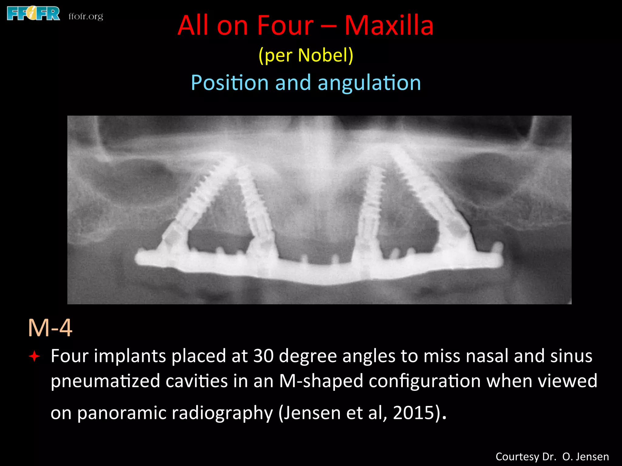 Angled implants | PDF