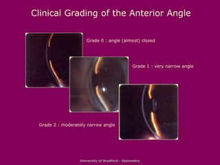 Angle drainage | PPT