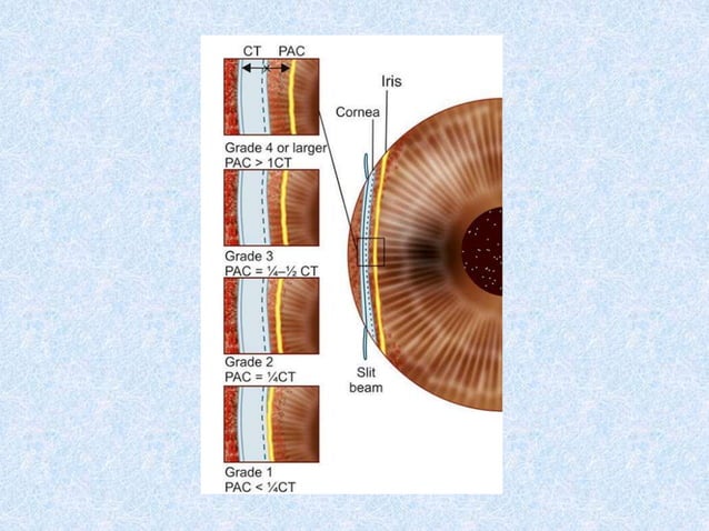 Angle of Anterior Chamber smch.......... | PPTX | Eye and Vision ...