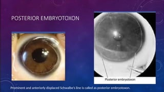 Angle of anterior chamber (2).presentation | PPTX