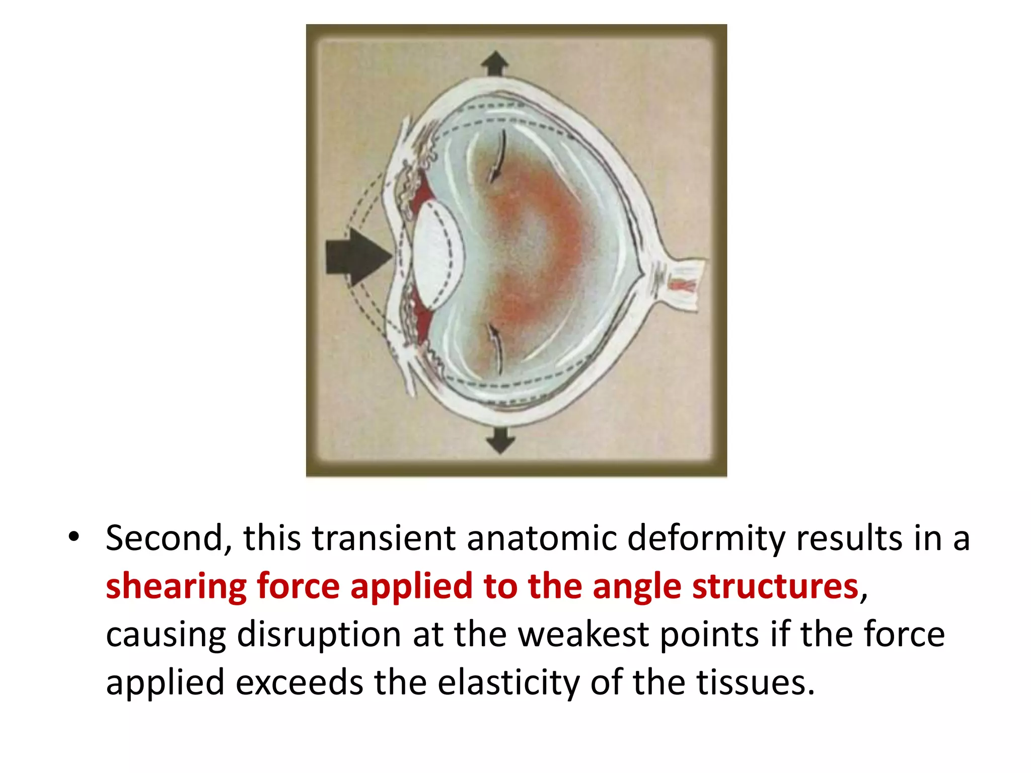 Angle recession glaucoma | PPTX