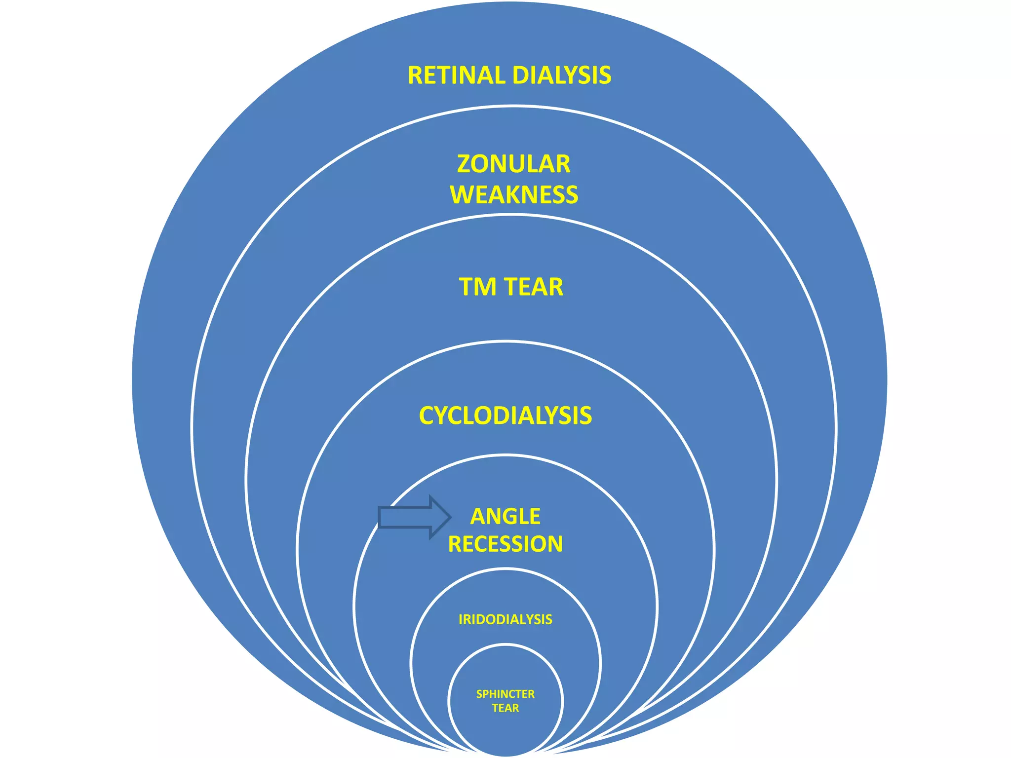 Angle recession glaucoma | PPTX