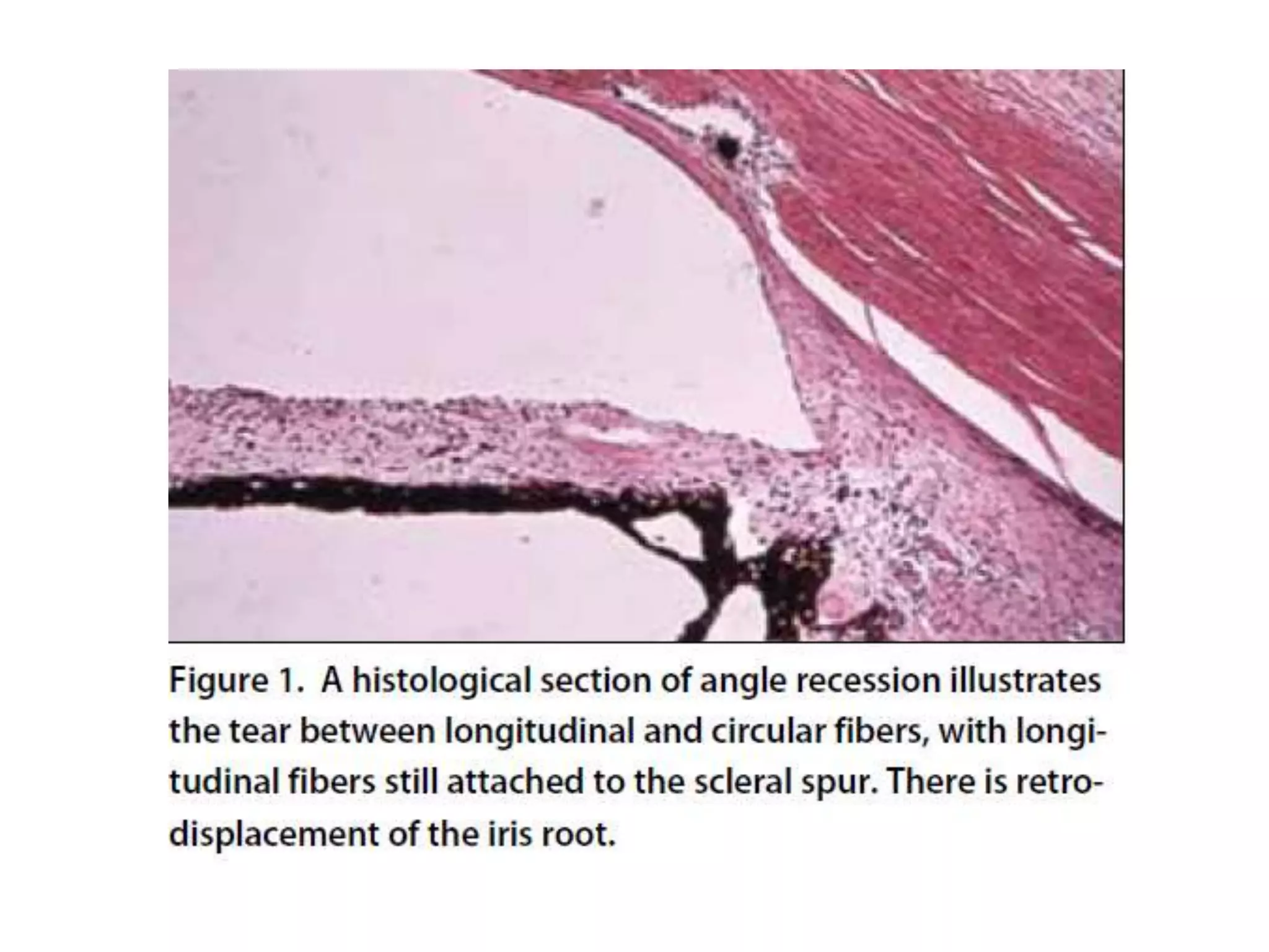Angle recession glaucoma | PPTX