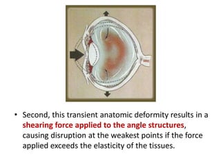 Angle recession glaucoma | PPTX