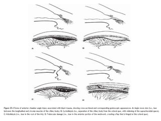 Angle recession glaucoma | PPTX