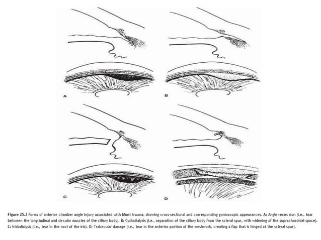 Angle recession glaucoma | PPTX