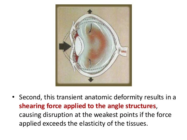 Angle recession glaucoma