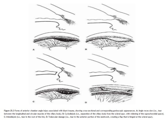 Angle recession glaucoma