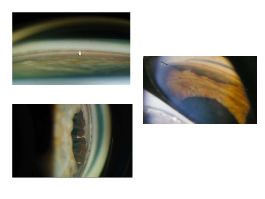 Angle recession glaucoma