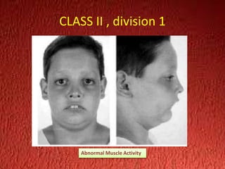 Angle's classification of malocclusion | PPTX | Dental Health ...