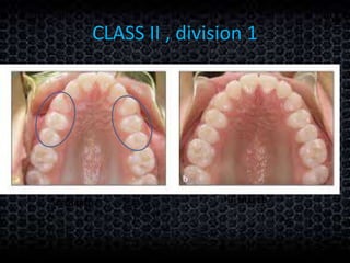 Angle's classification of malocclusion | PPTX | Dental Health ...