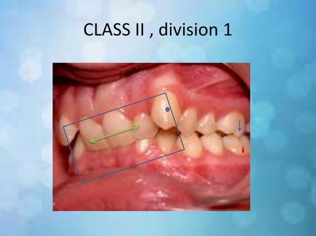 Angle's classification of malocclusion | PPTX | Dental Health ...