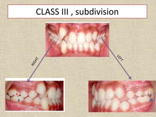 Angle's classification of malocclusion | PPTX | Dental Health ...