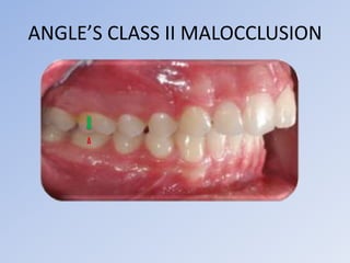 Angle's classification of malocclusion | PPTX | Dental Health ...