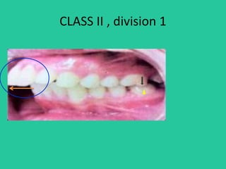 Angle's classification of malocclusion | PPTX | Dental Health ...