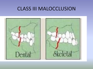 Angle's classification of malocclusion | PPT