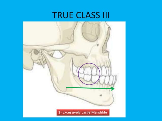 Angle's classification of malocclusion | PPT