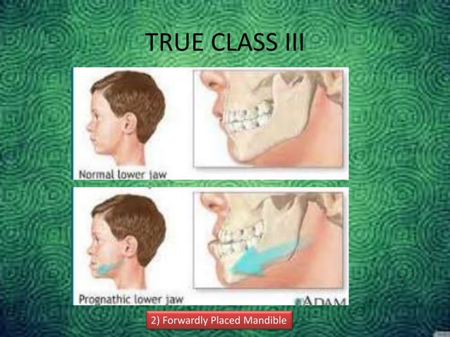 Angle's classification of malocclusion | PPT