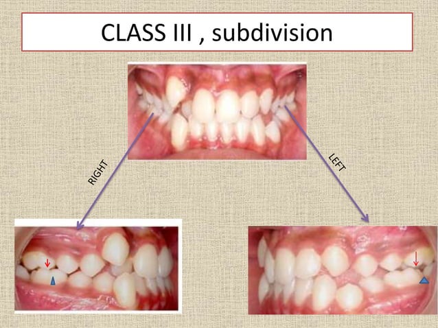 Angle's classification of malocclusion | PPT