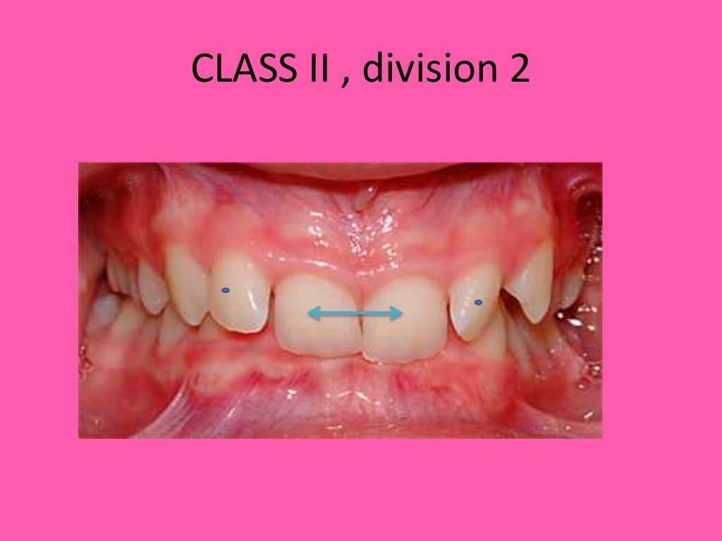 Angle's classification of malocclusion