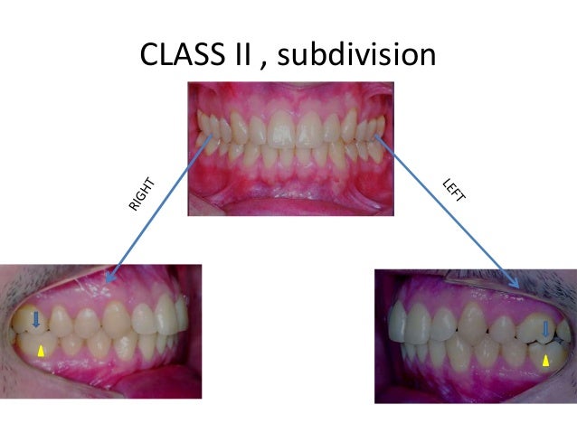 Angles Classification Of Malocclusion