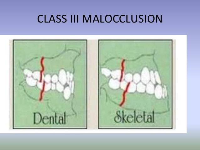 Angle's classification of malocclusion