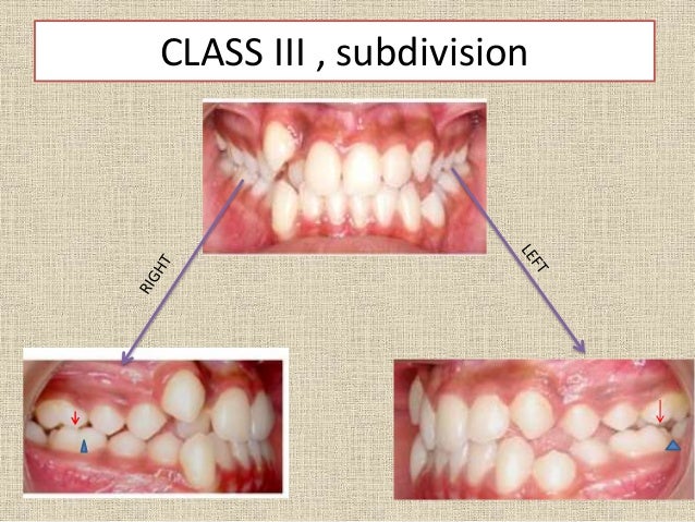 Angle's classification of malocclusion